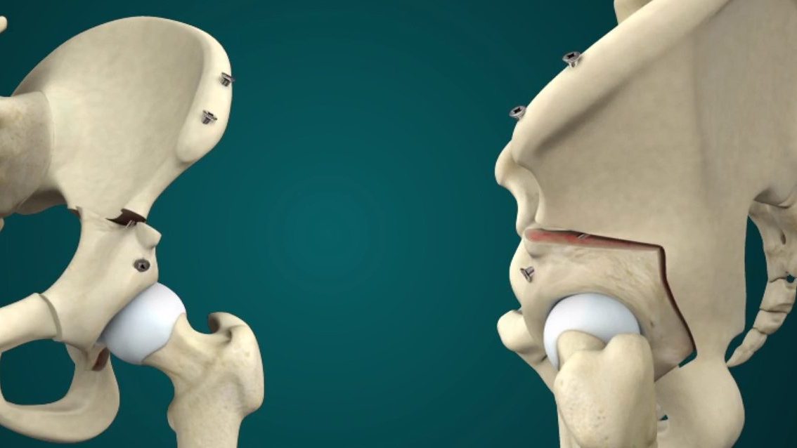 Hip Preservation Denver | Hip Preservation Specialist Denver